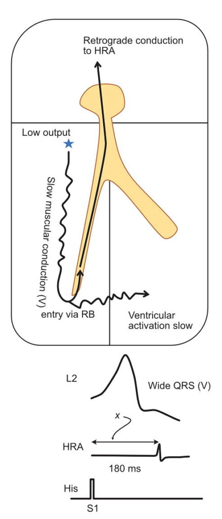 Parahisian Pacing | EP Made Easy!
