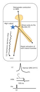 Parahisian Pacing | EP Made Easy!