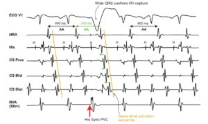 His synchronous PVC | EP Made Easy!
