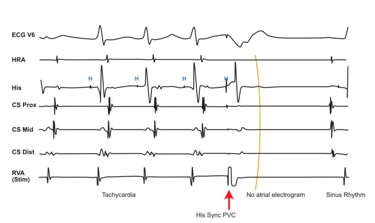 His synchronous PVC | EP Made Easy!