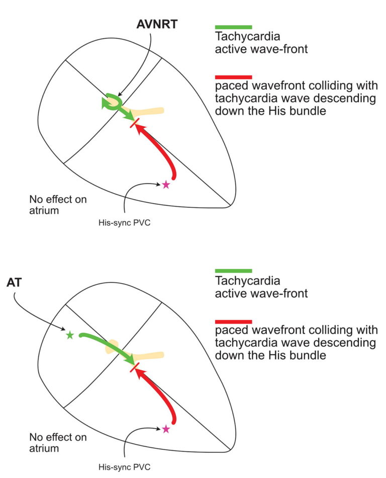 His synchronous PVC | EP Made Easy!