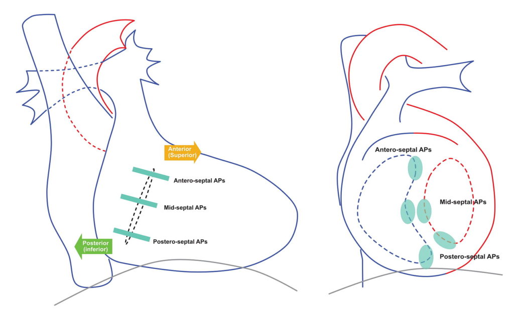 ECG Analysis of Pre-excitation (WPW) without algorithms | EP Made Easy!
