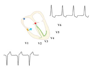 ECG Analysis of Pre-excitation (WPW) without algorithms | EP Made Easy!