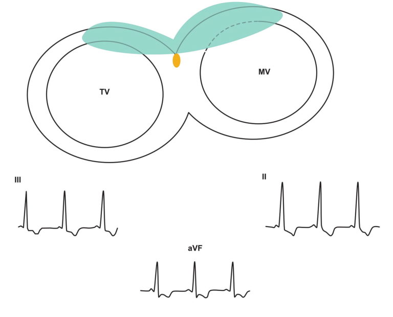 ECG Analysis of Pre-excitation (WPW) without algorithms | EP Made Easy!