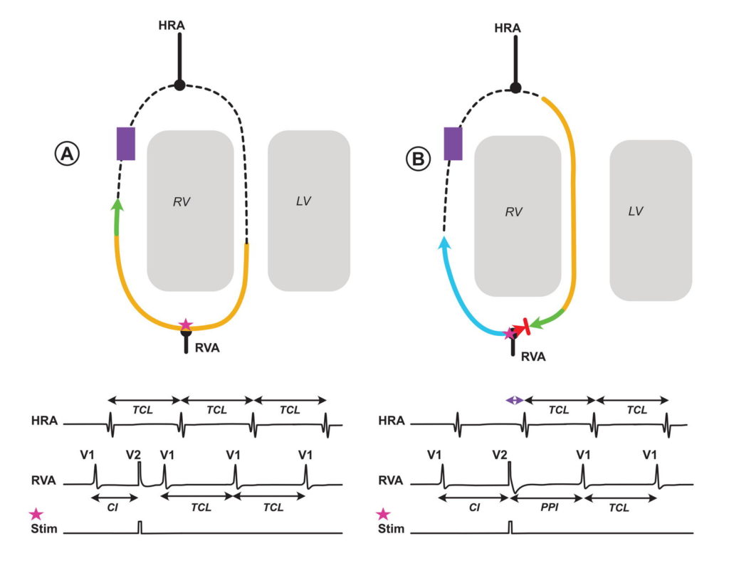 Pre-excitation Index | EP Made Easy!