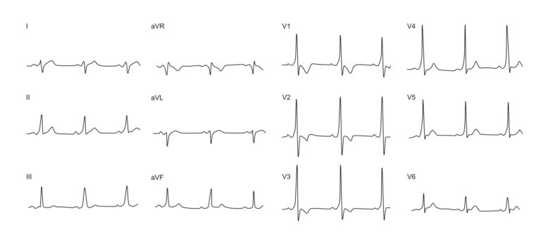 ECG Analysis of Pre-excitation (WPW) without algorithms | EP Made Easy!