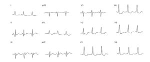 ECG Analysis of Pre-excitation (WPW) without algorithms | EP Made Easy!