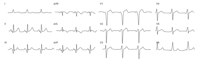 ECG Analysis of Pre-excitation (WPW) without algorithms | EP Made Easy!
