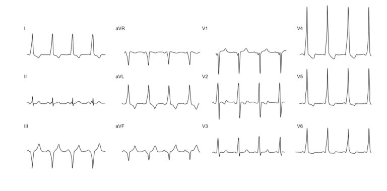 ECG Analysis of Pre-excitation (WPW) without algorithms | EP Made Easy!